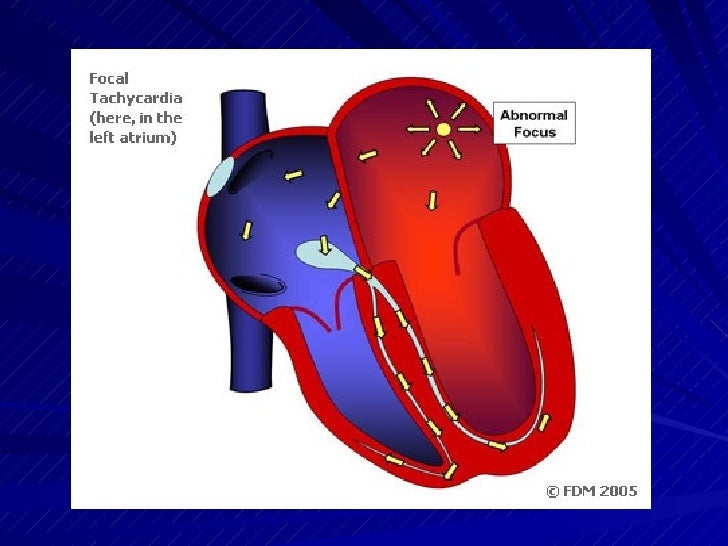 Atrial Tachycardia