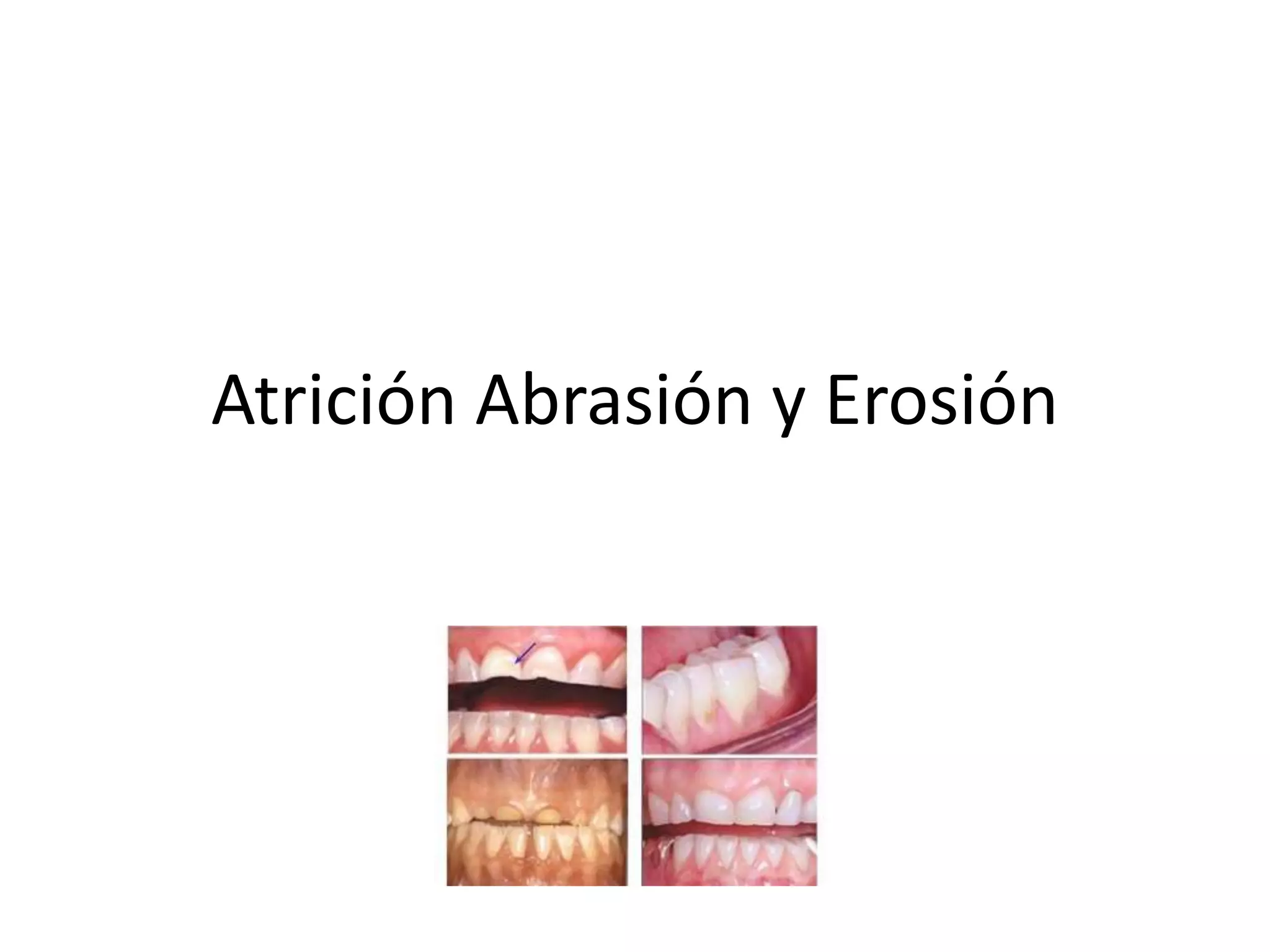 Atrición abrasión y erosión | PPTX