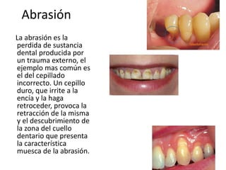 Atrición abrasión y erosión | PPTX