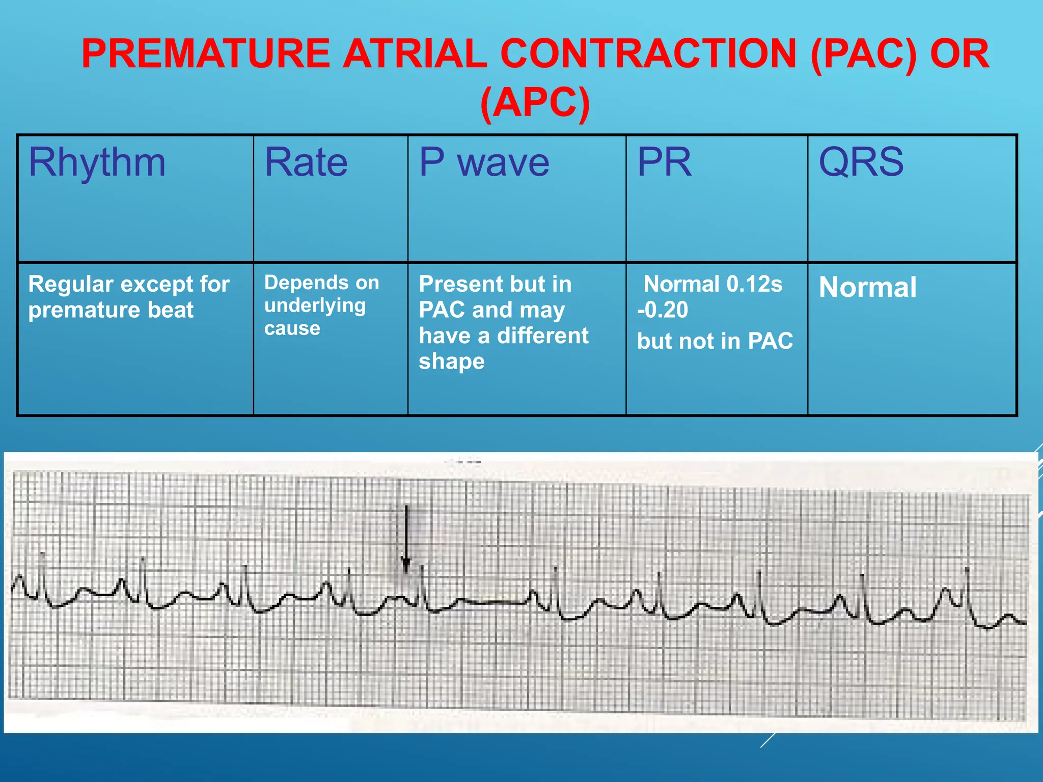 lecture on Atrial dyshyrithmias of heart | PPTX