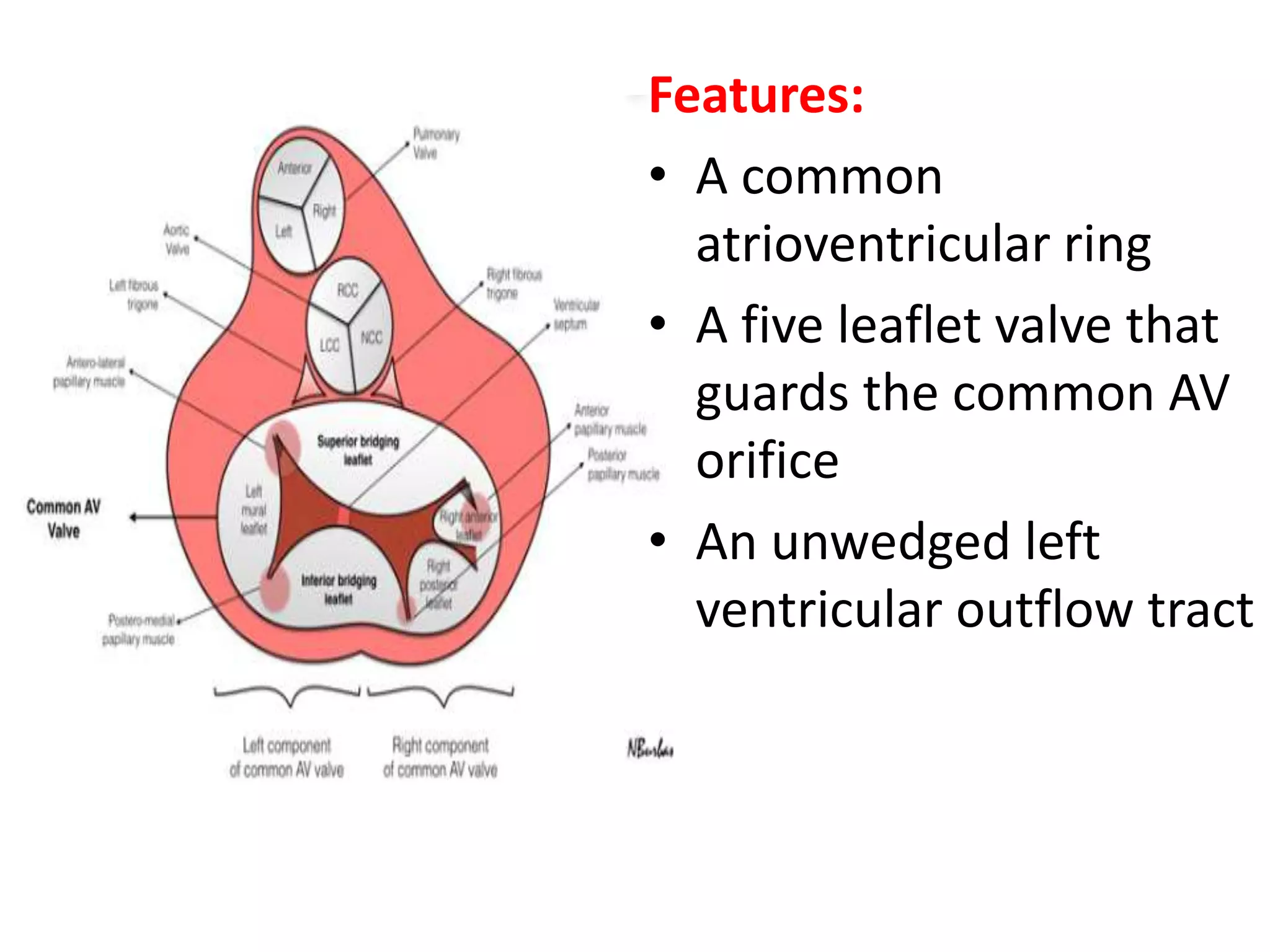 Atrioventricular canal defect | PPTX