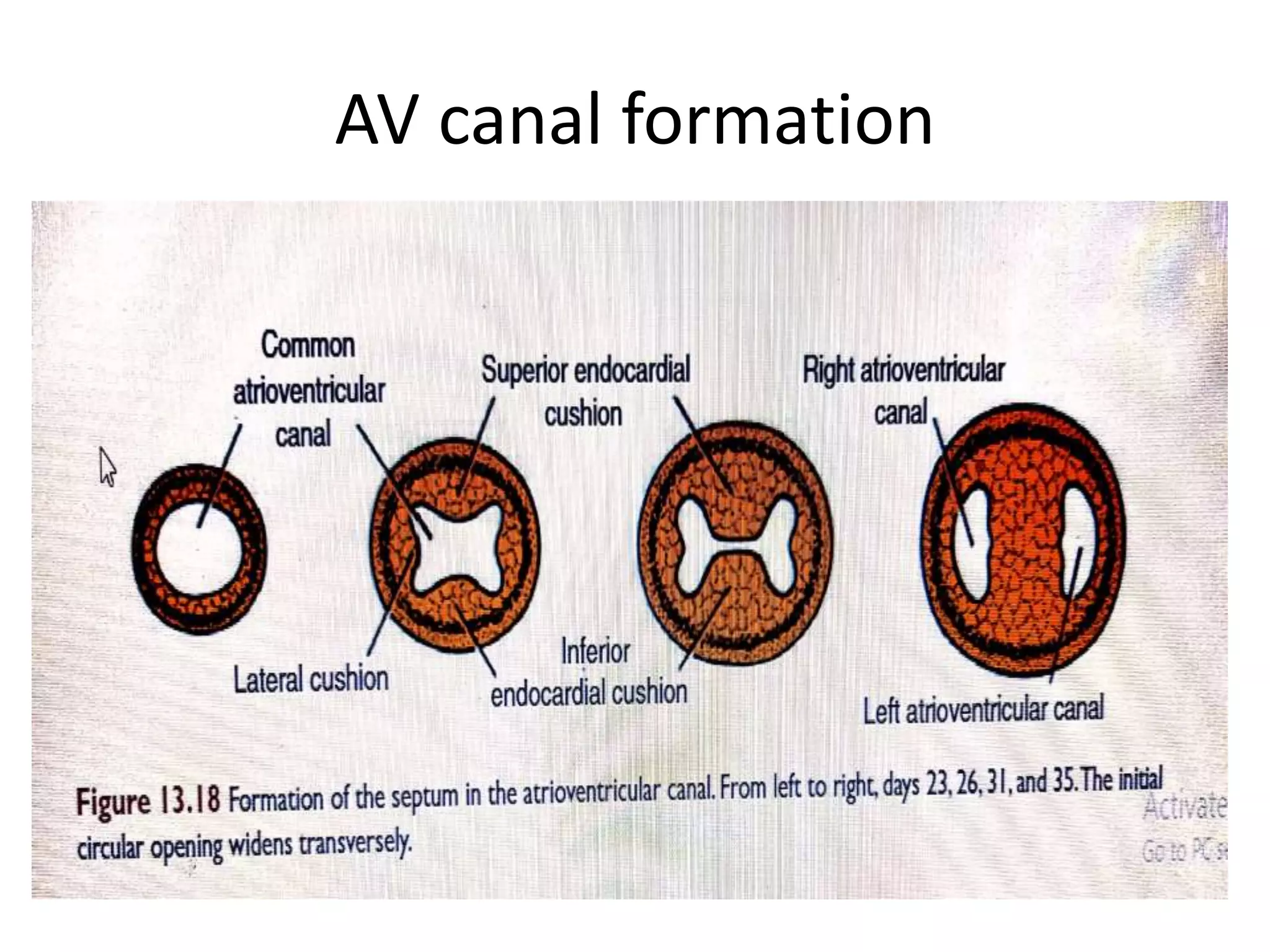 Atrioventricular canal defect | PPTX