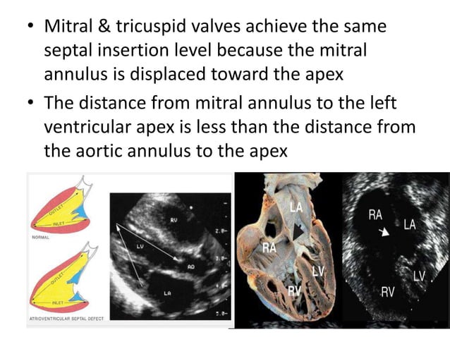 Atrioventricular canal defect | PPTX | Heart and Cardiovascular ...