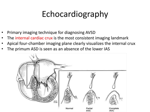 Atrioventricular canal defect | PPTX | Heart and Cardiovascular ...