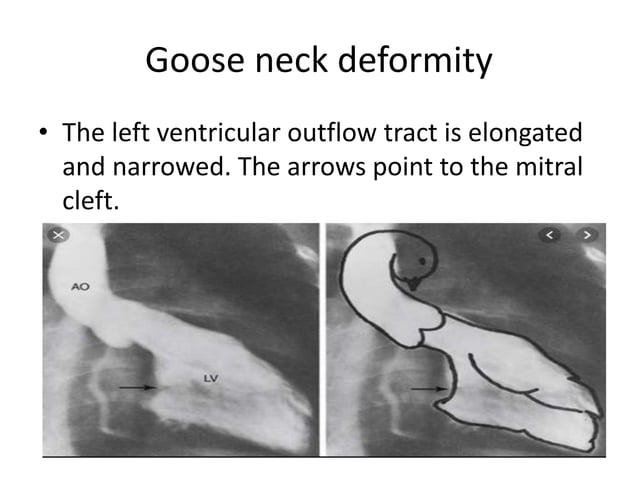 Atrioventricular canal defect | PPTX | Heart and Cardiovascular ...