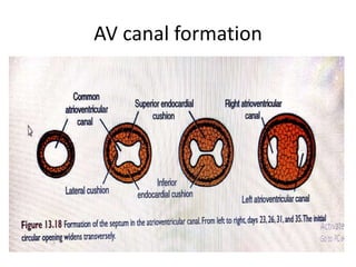 Atrioventricular canal defect | PPTX