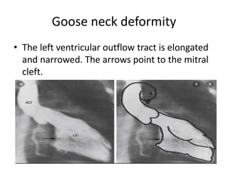 Endocardial Cushion Defect Echo