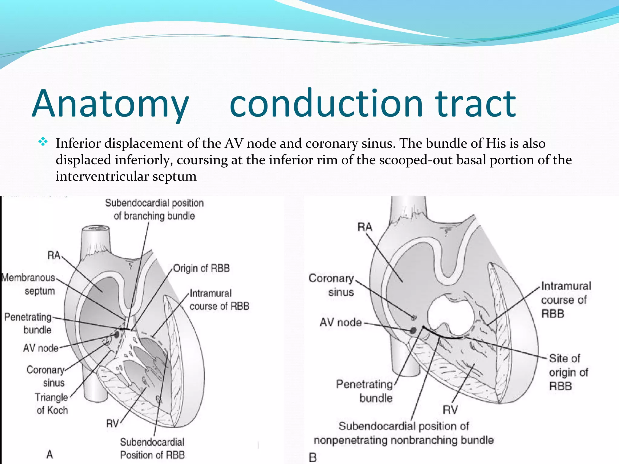 Atrioventricular canal defect, Firas Aljanadi,MD | PPT