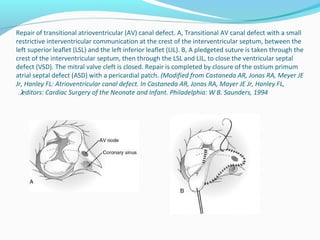 Transitional Av Canal Defect