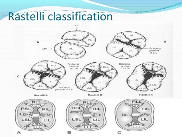 Atrioventricular canal defect, Firas Aljanadi,MD