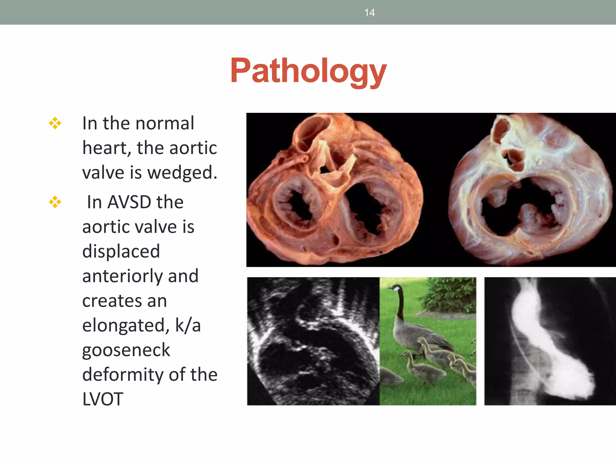 Atrioventricular septal defects | PPTX