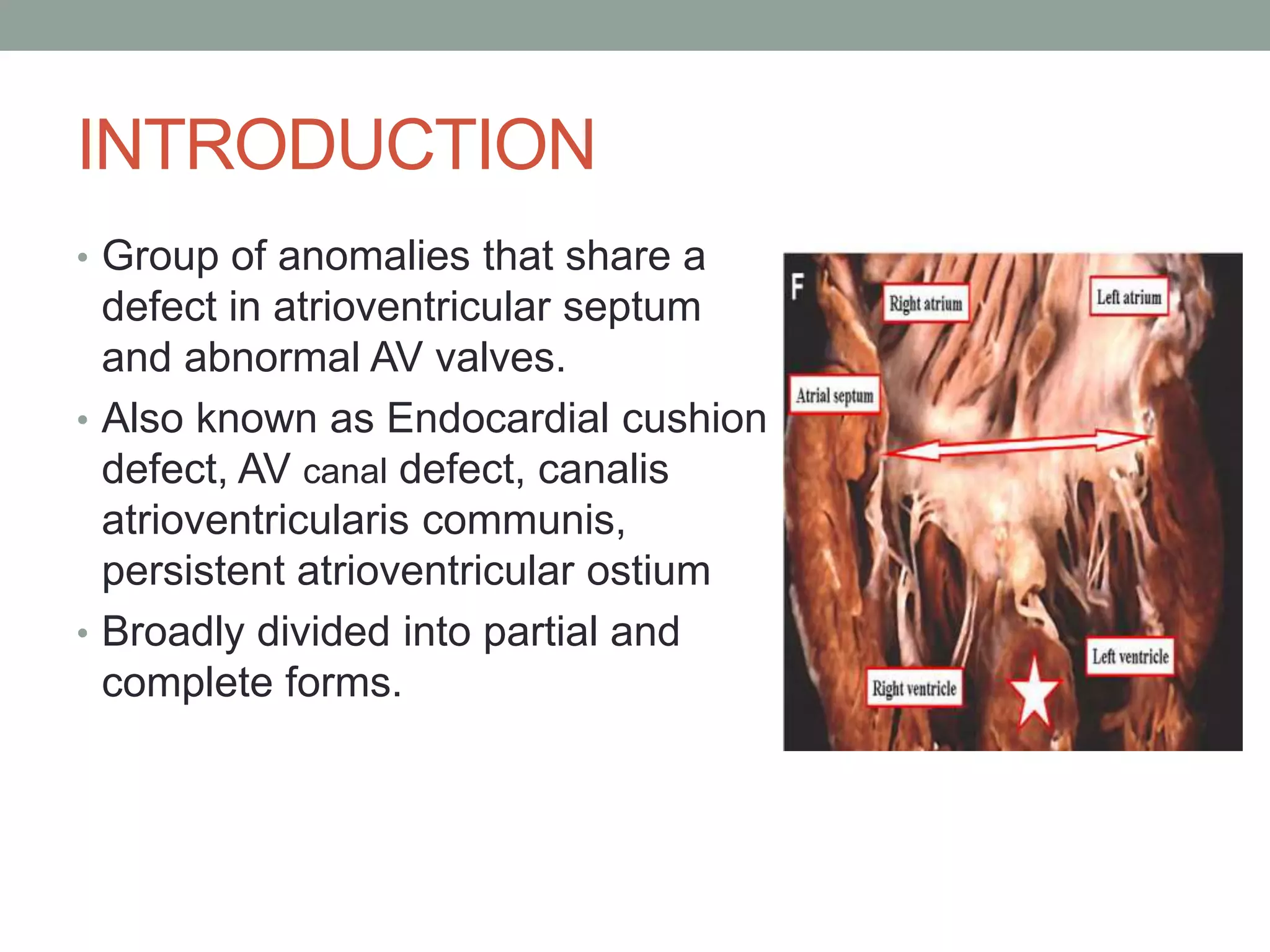 Atrioventricular septal defects | PPTX