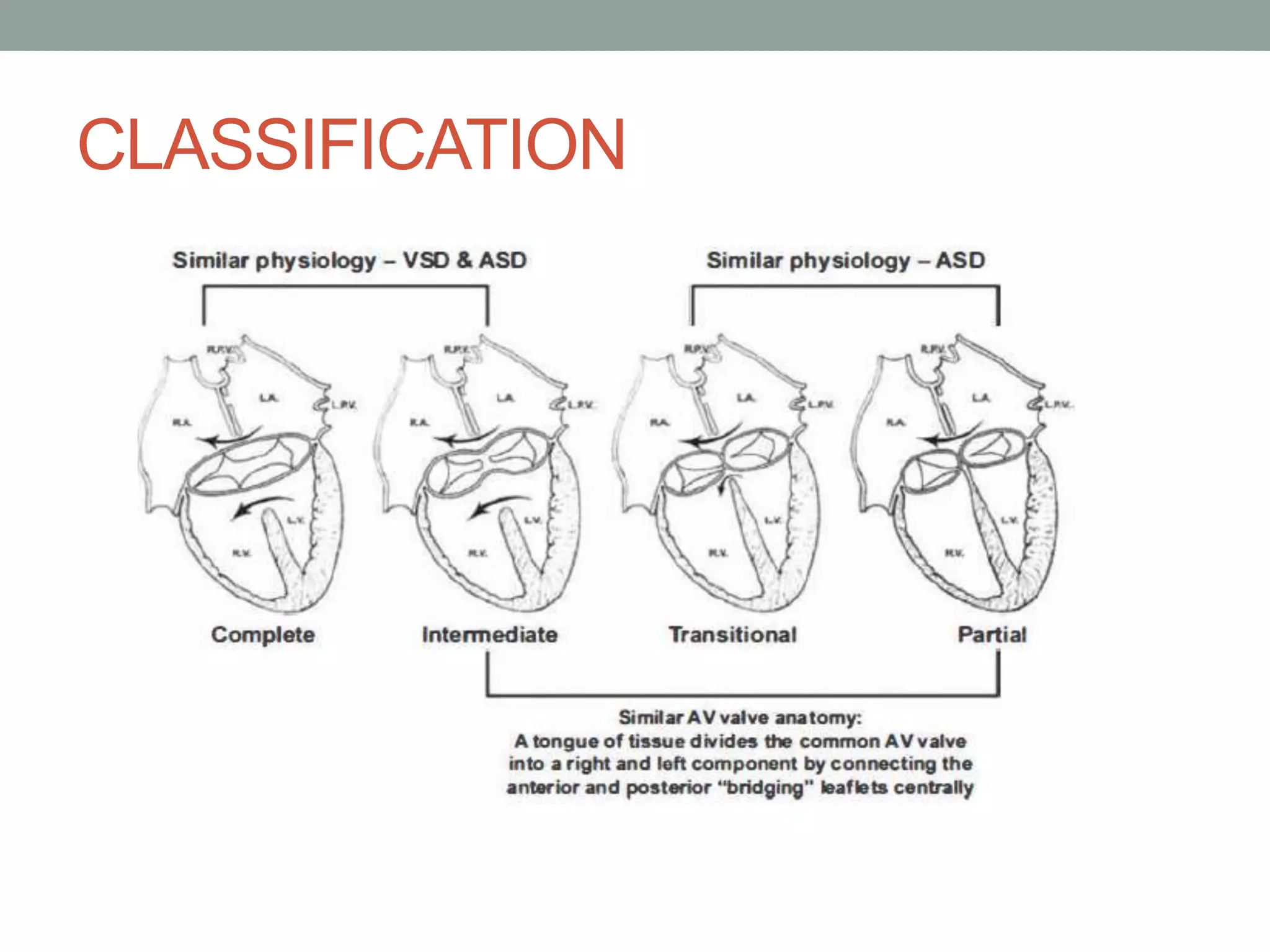 Atrioventricular septal defects | PPTX