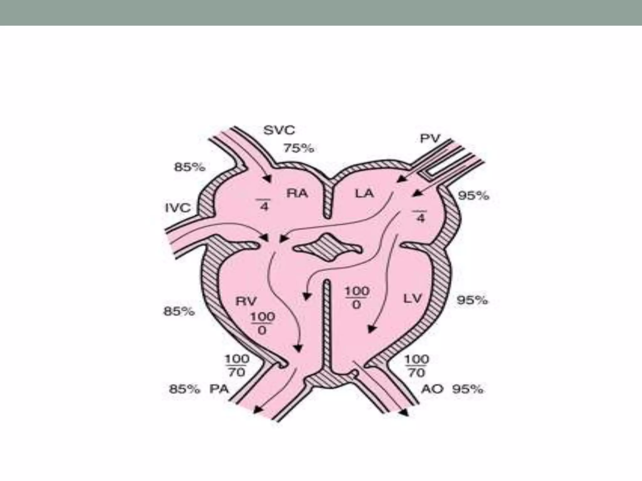 Atrioventricular septal defects | PPTX