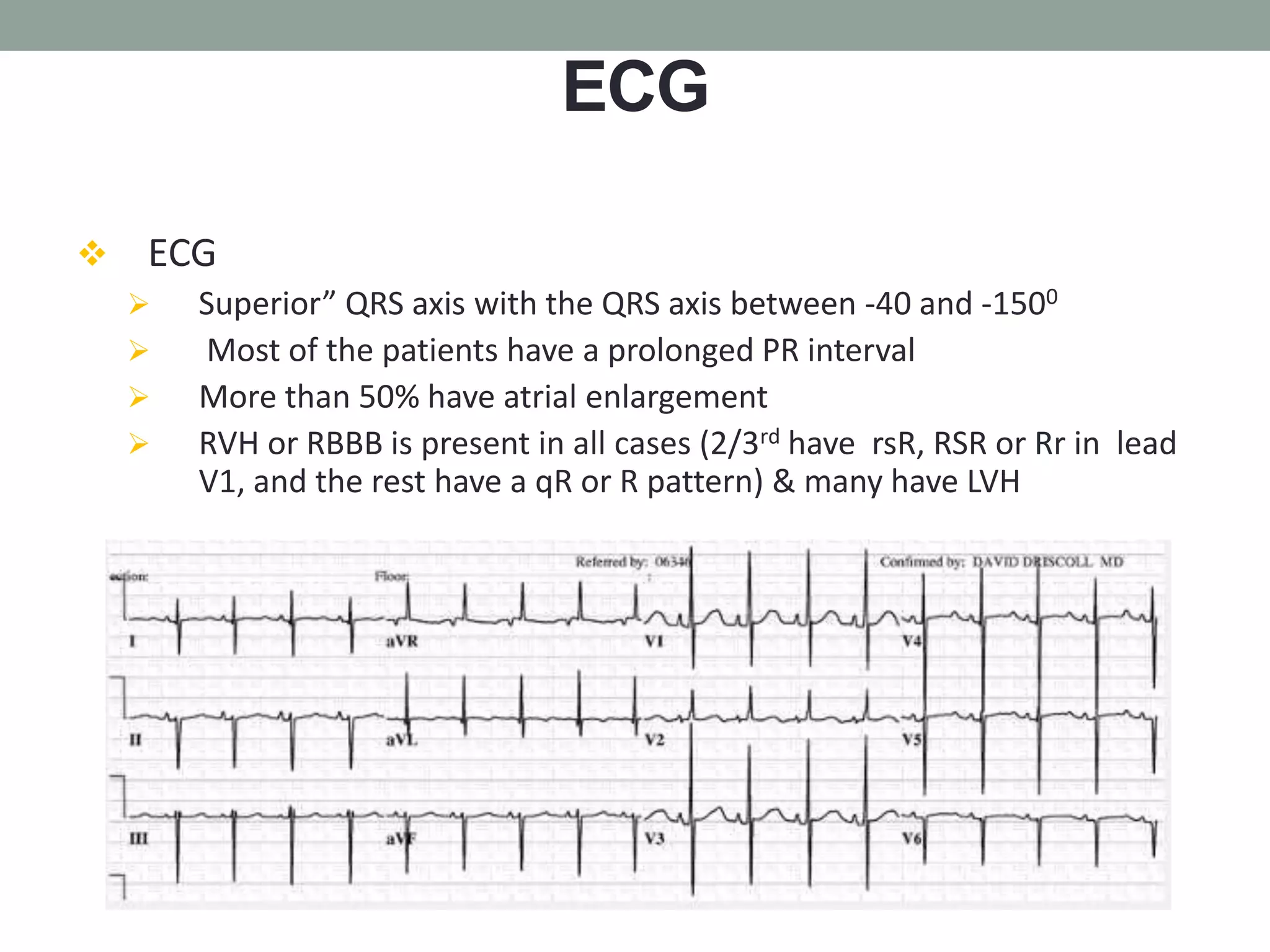 Atrioventricular septal defects | PPTX