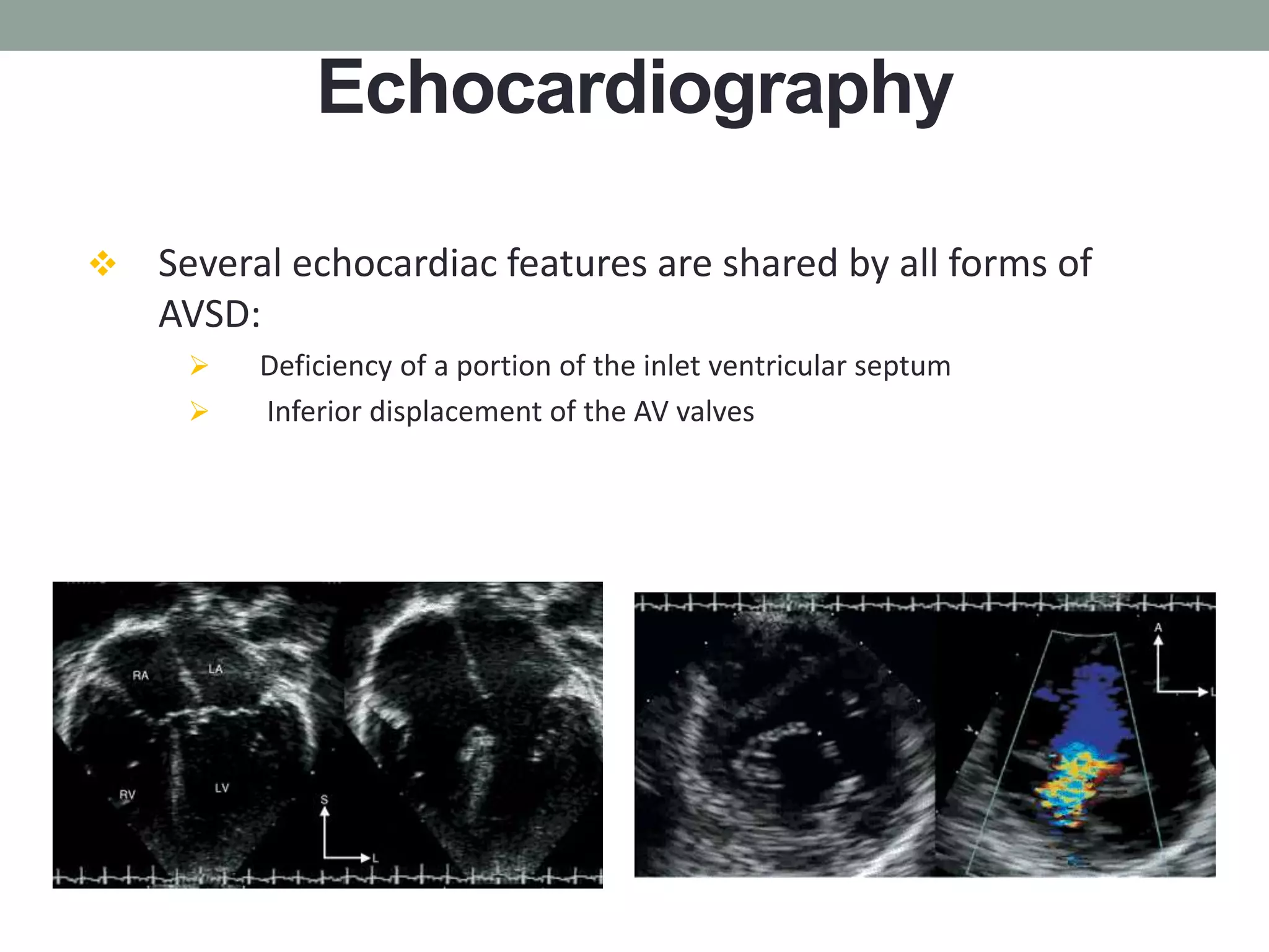 Atrioventricular septal defects | PPTX