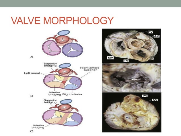 Atrioventricular septal defects | PPTX | Heart and Cardiovascular ...