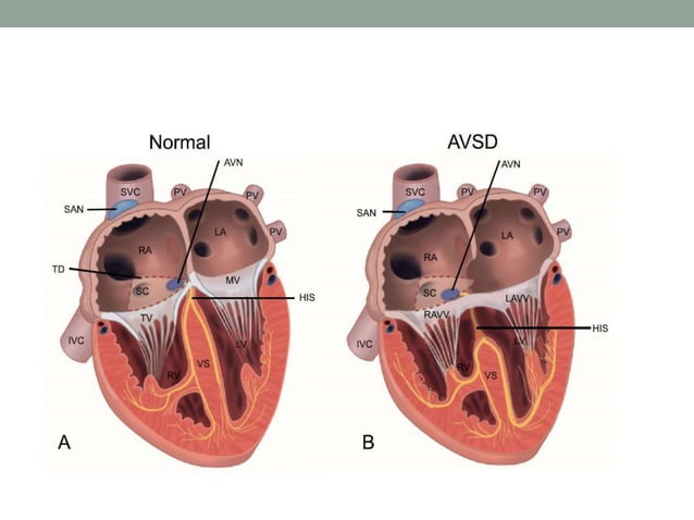Atrioventricular septal defects | PPTX | Heart and Cardiovascular ...
