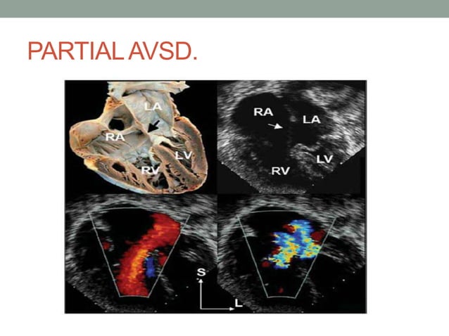 Atrioventricular septal defects | PPTX | Heart and Cardiovascular ...