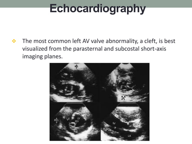 Atrioventricular septal defects | PPTX | Heart and Cardiovascular ...