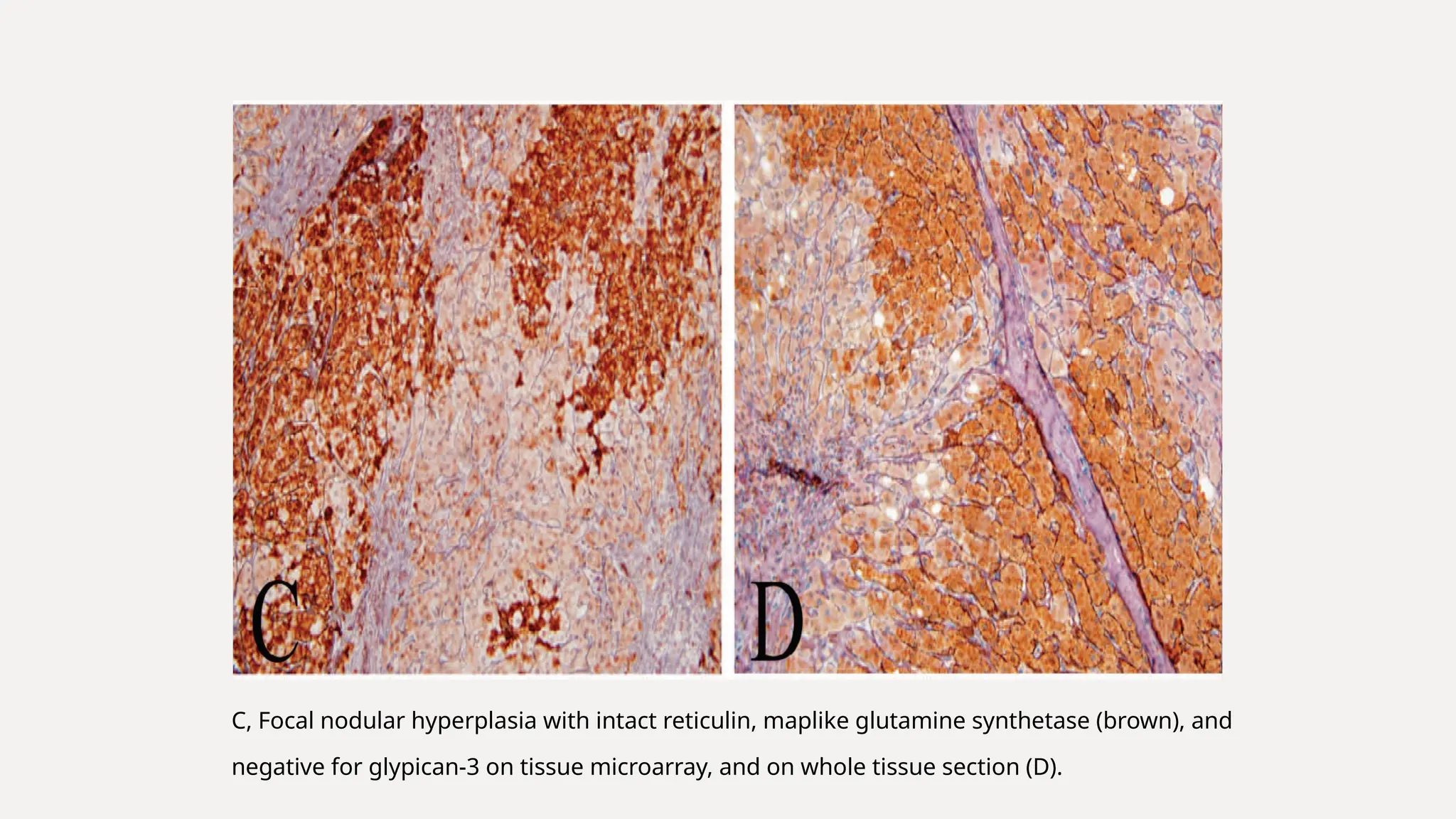 A Triple Stain of Reticulin, Glypican-3,.pptx