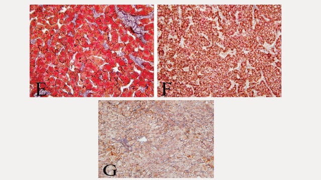 A Triple Stain of Reticulin, Glypican-3,.pptx