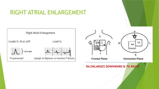 ATRIUM ECG presentation describe about right and left atrial enlarge ...