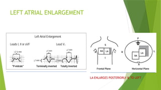 ATRIUM ECG presentation describe about right and left atrial enlarge ...