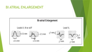 ATRIUM ECG presentation describe about right and left atrial enlarge ...