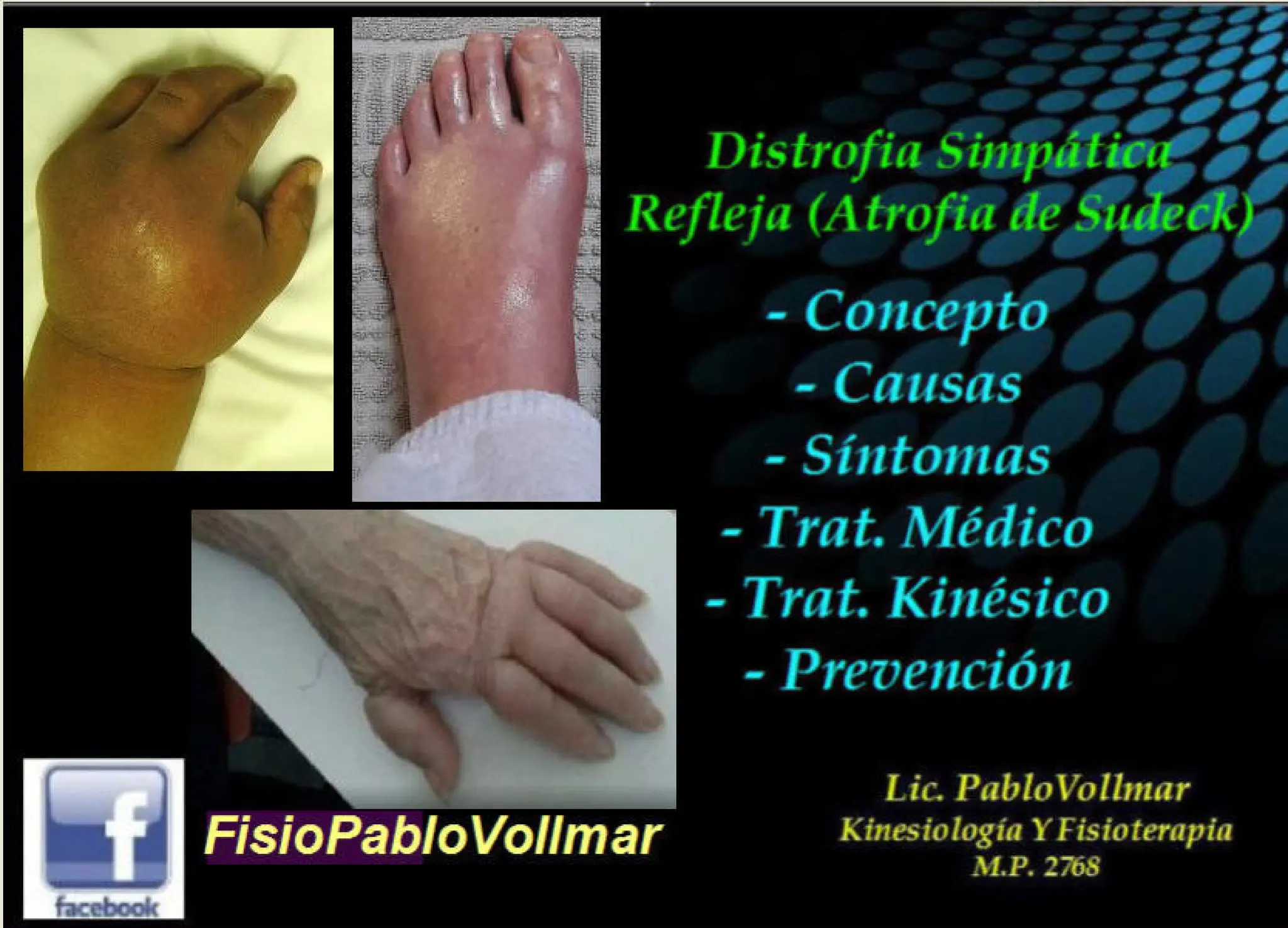 Atrofia de Sudeck Distrofia simpatica refleja sindrome complejo ...