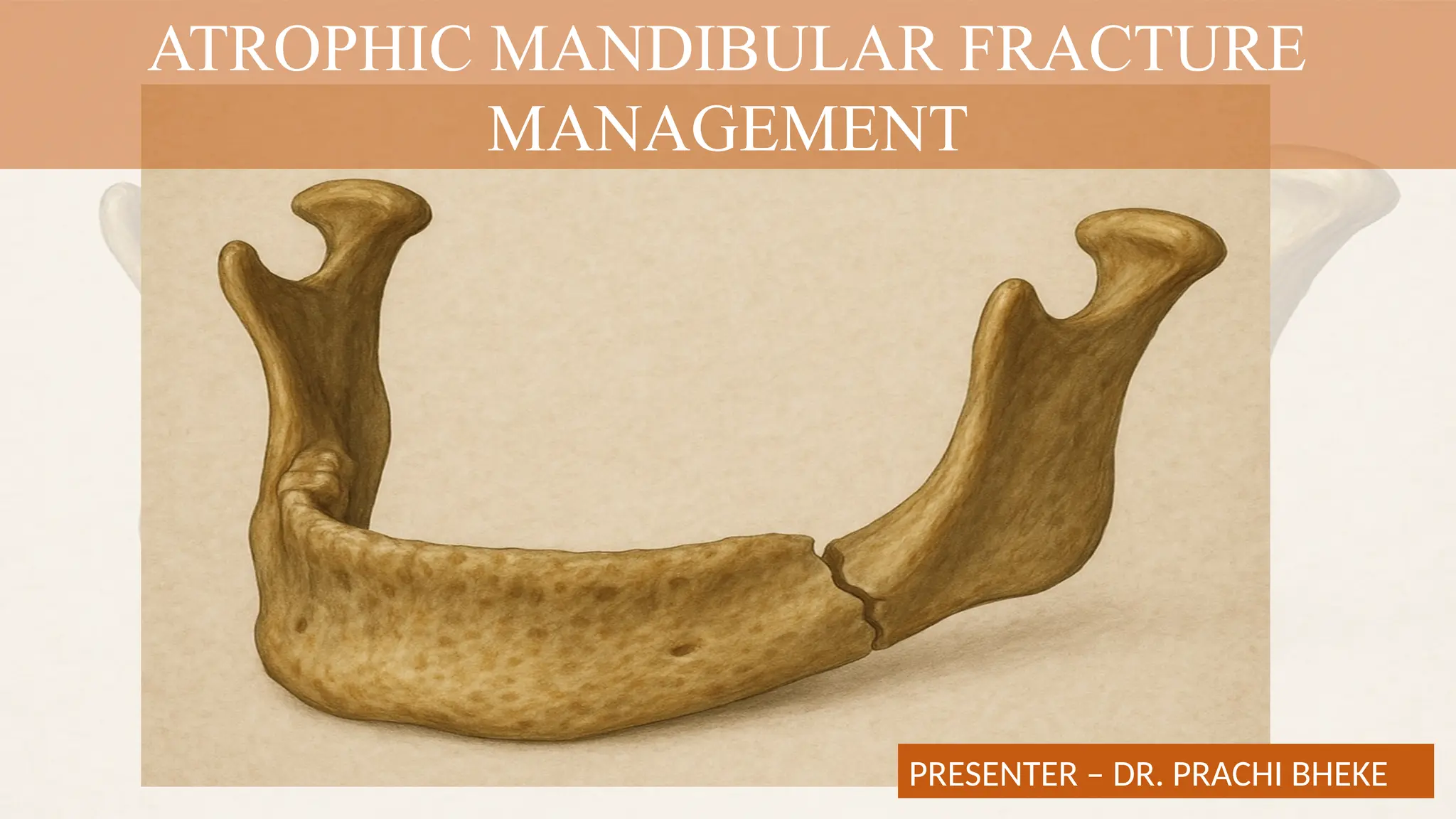 Atrophic mandible fracture management .pptx