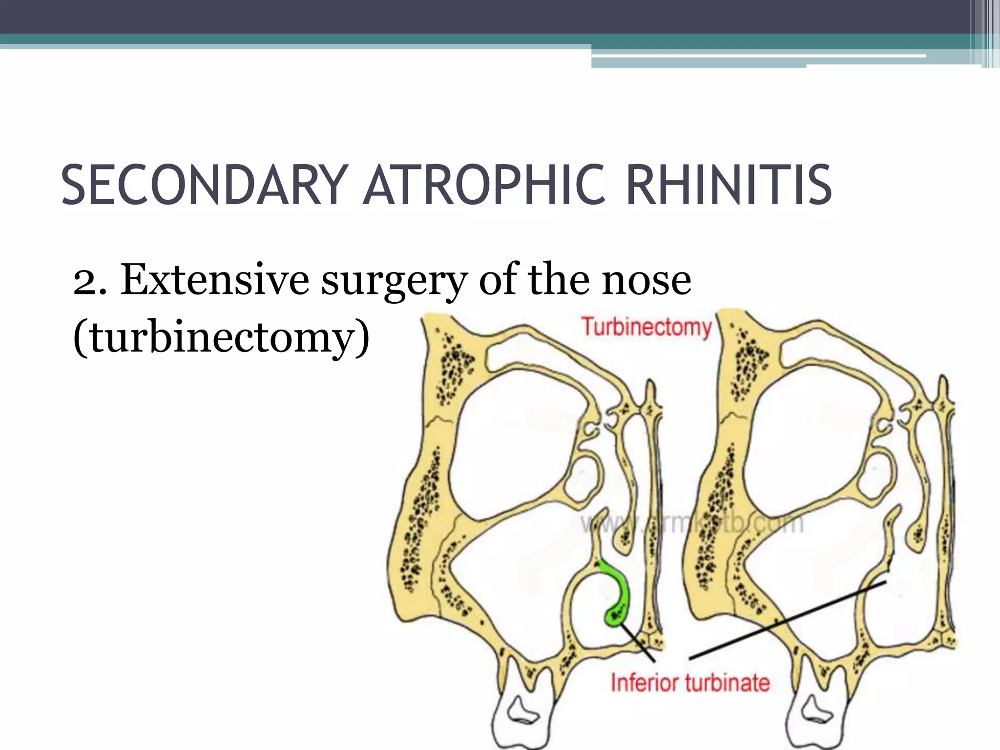 Atrophic rhinitis ppt | PPTX