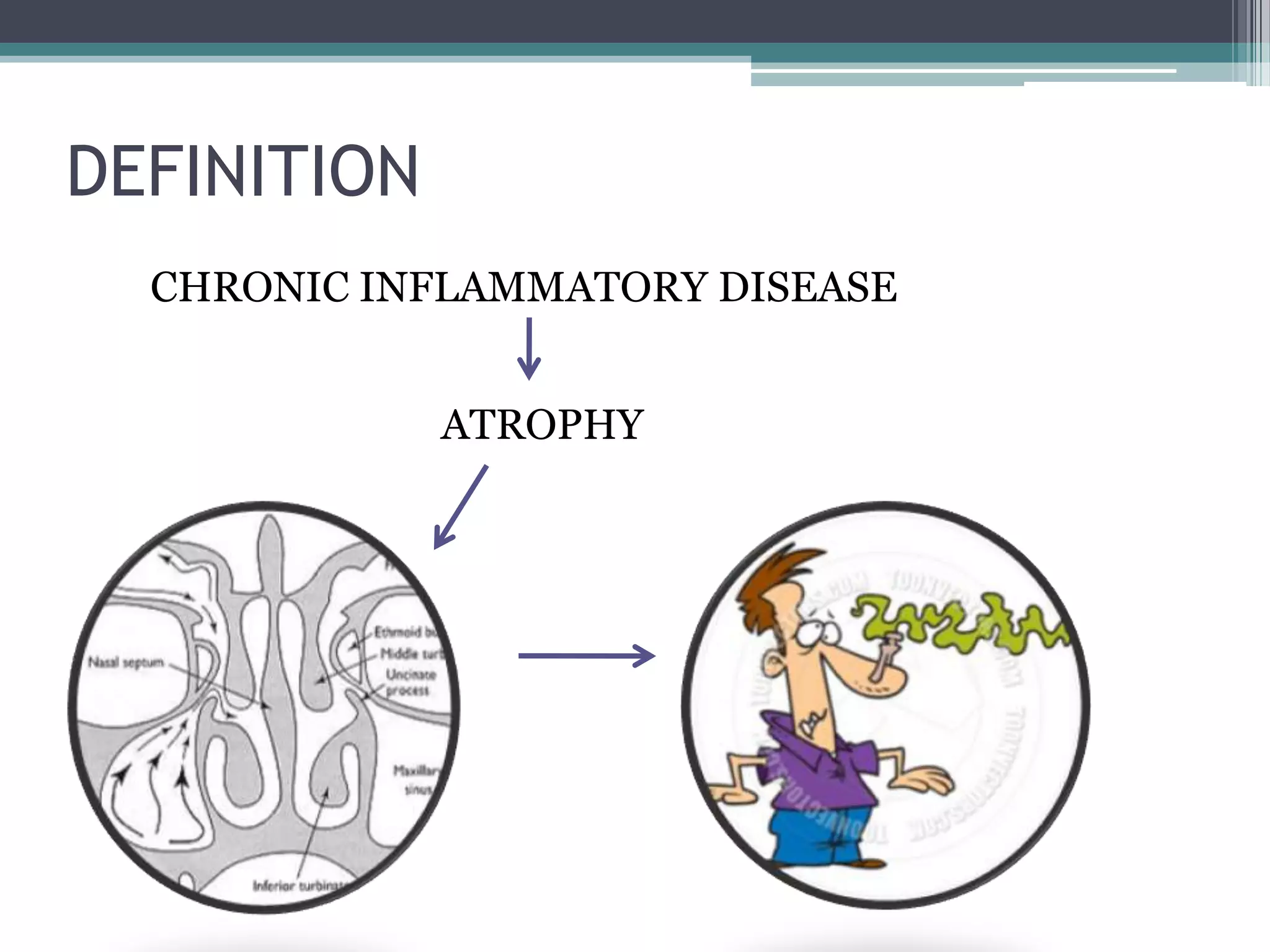 Atrophic rhinitis ppt | PPTX