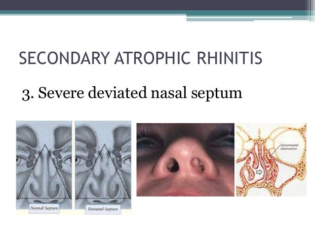 Atrophic rhinitis ppt