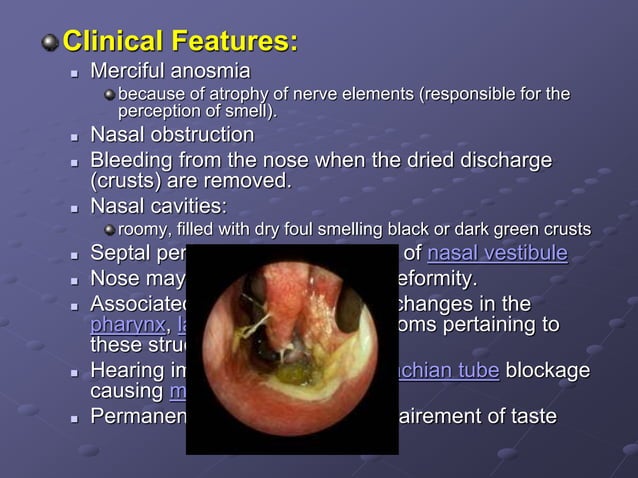 Atrophic rhinitis | PPT