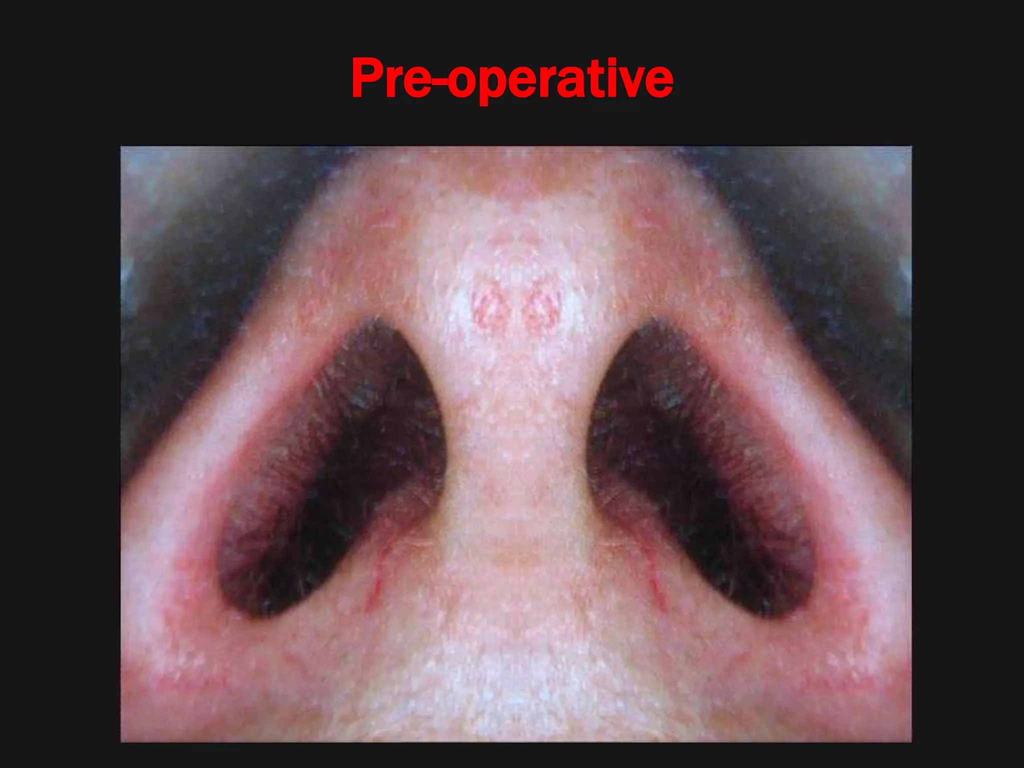 Atrophic rhinitis | PPT