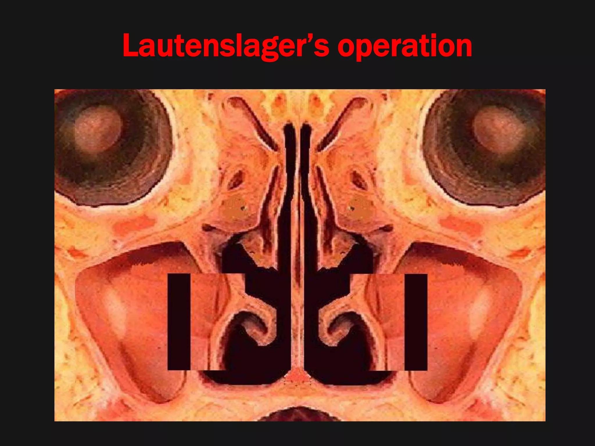 Atrophic rhinitis | PPT