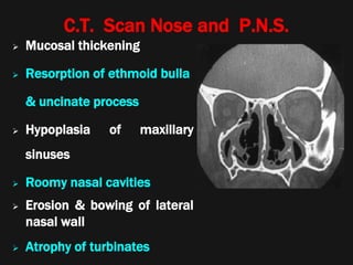 Atrophic rhinitis | PPT