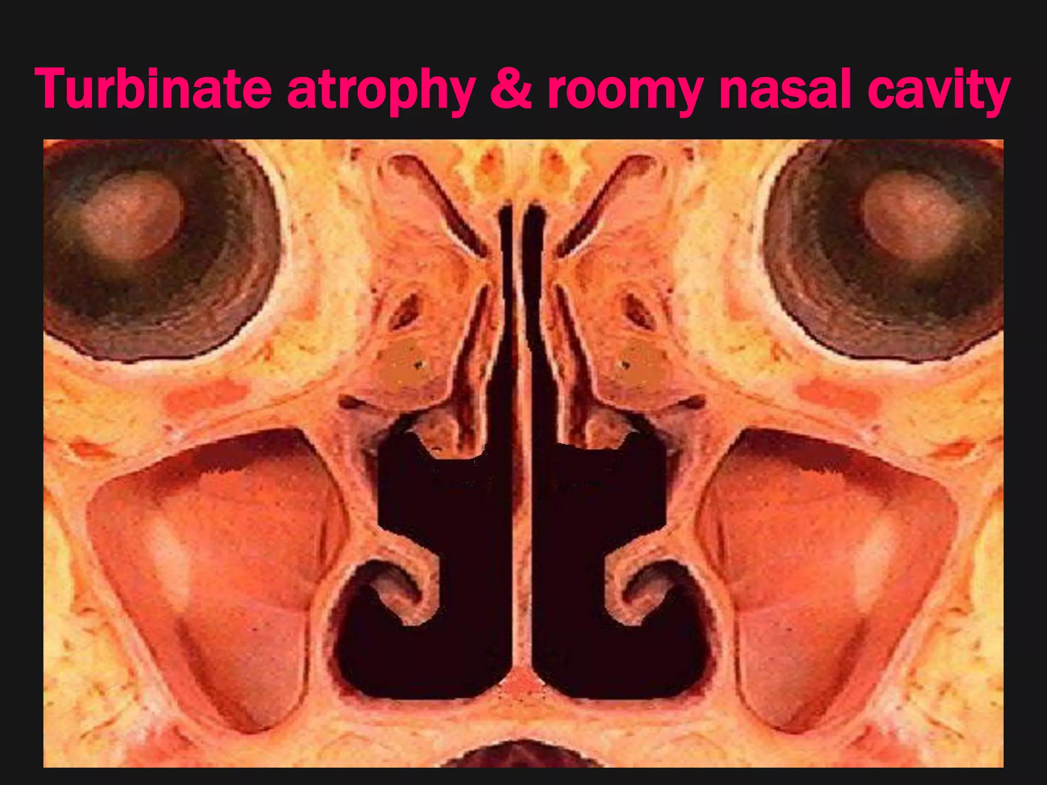 Atrophic rhinitis | PPT