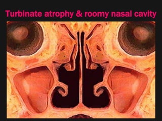 Atrophic rhinitis | PPT