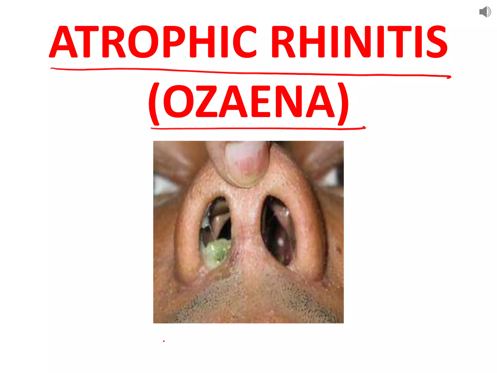 Atrophic rhinitis.pptx