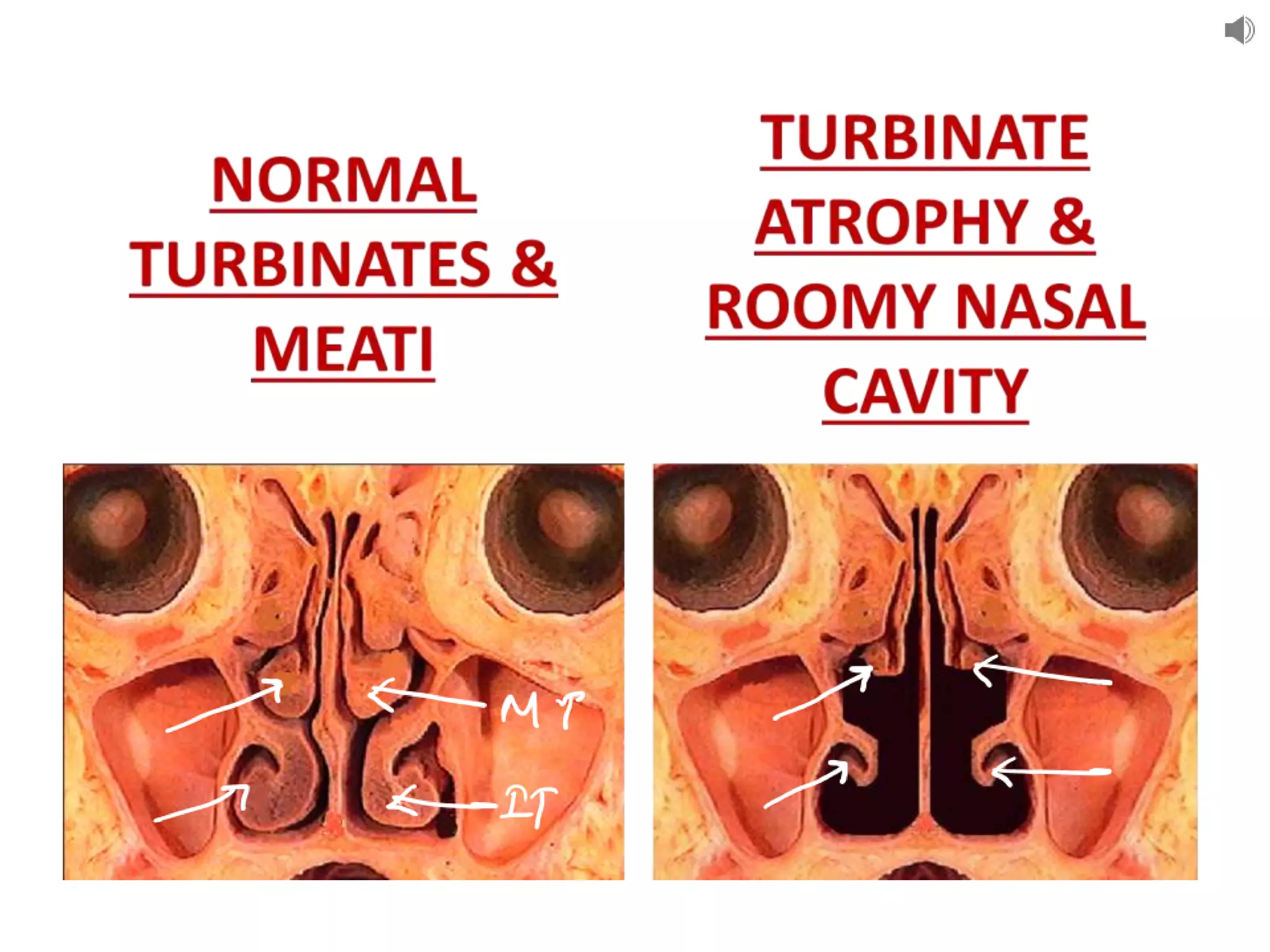 Atrophic rhinitis.pptx