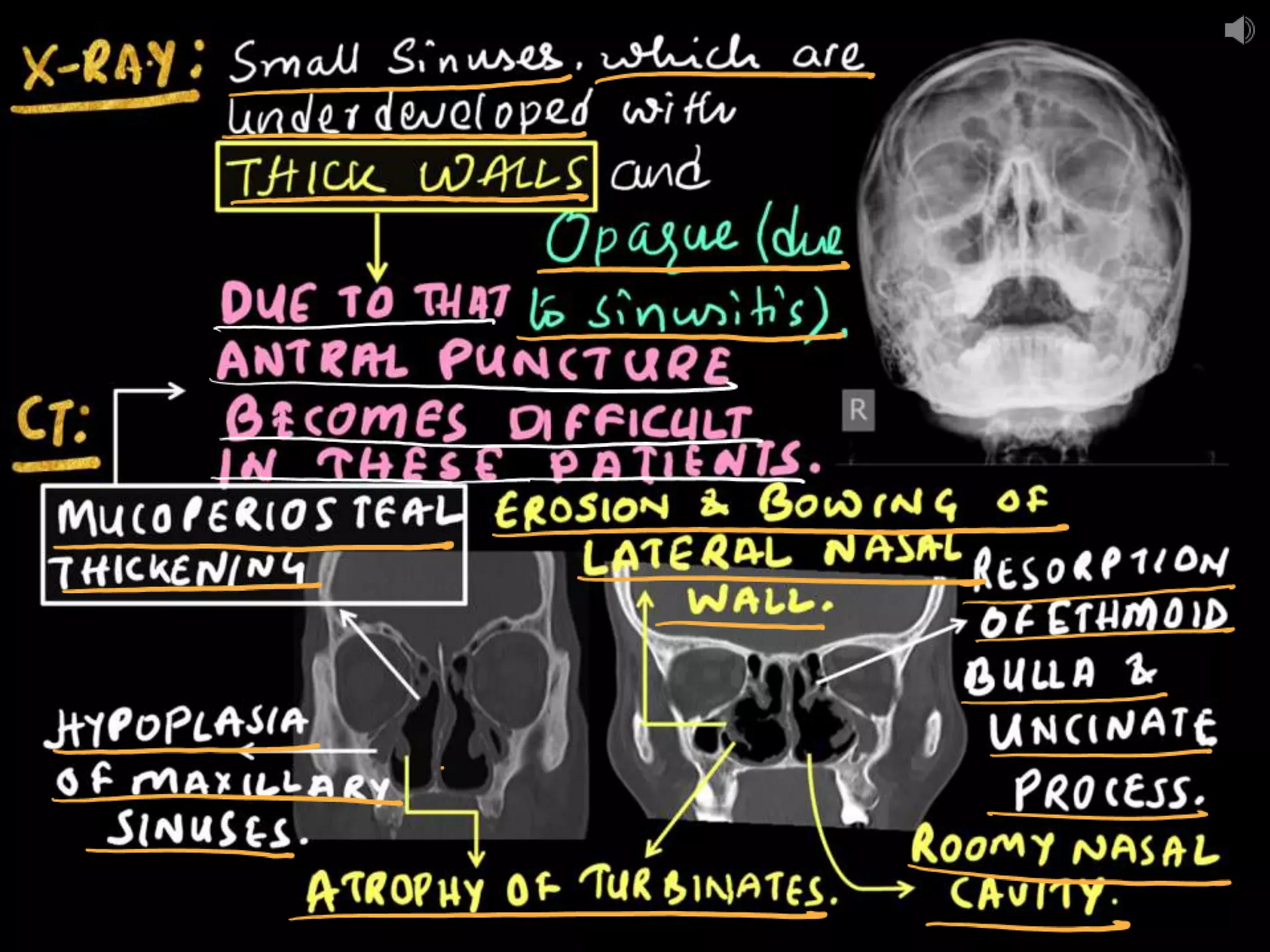 Atrophic rhinitis.pptx