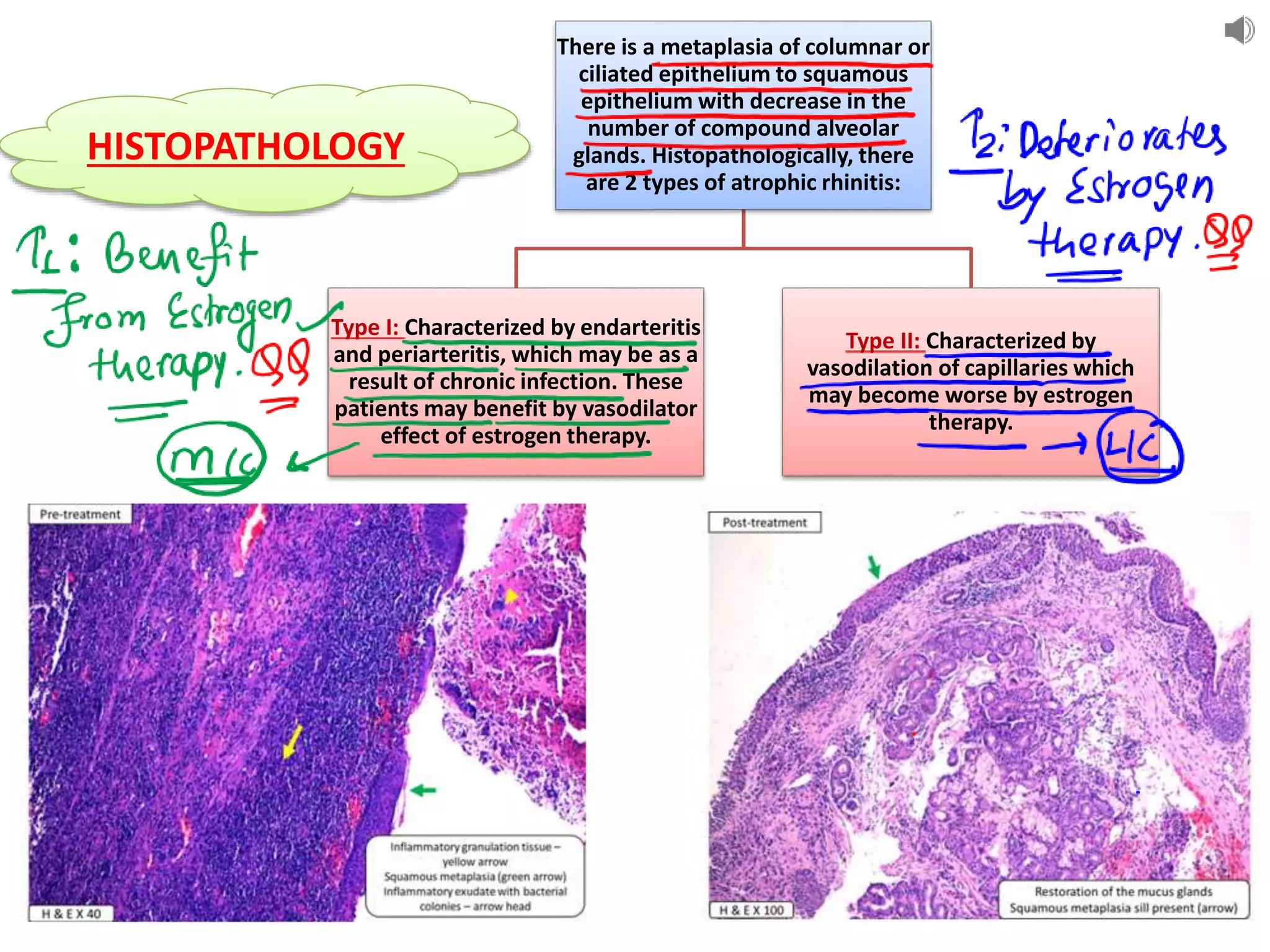 Atrophic rhinitis.pptx