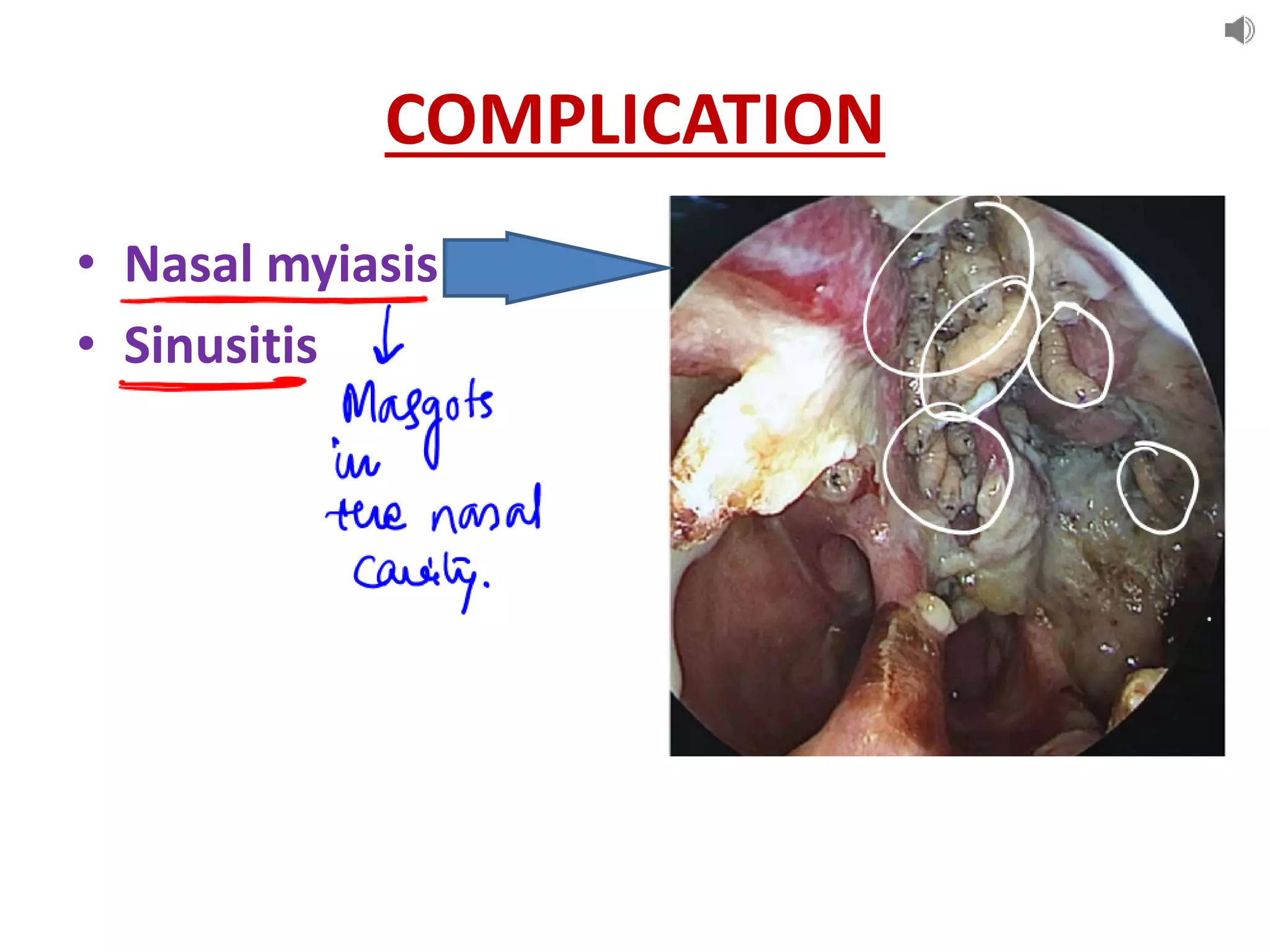 Atrophic rhinitis.pptx