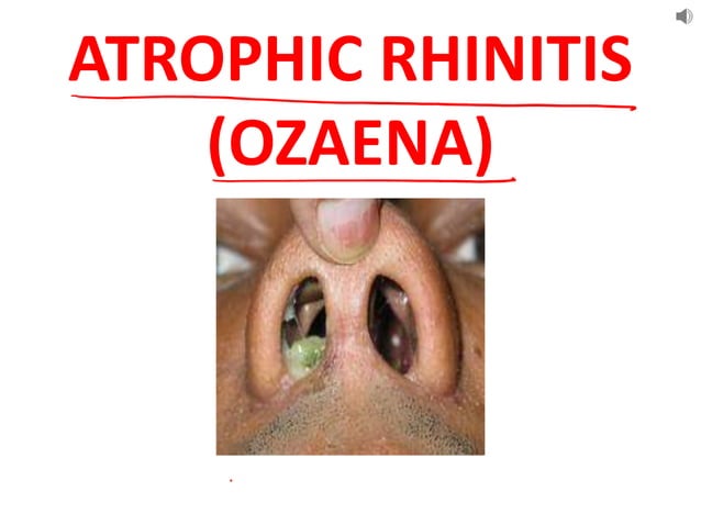 Atrophic rhinitis.pptx