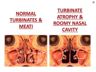 Atrophic rhinitis.pptx