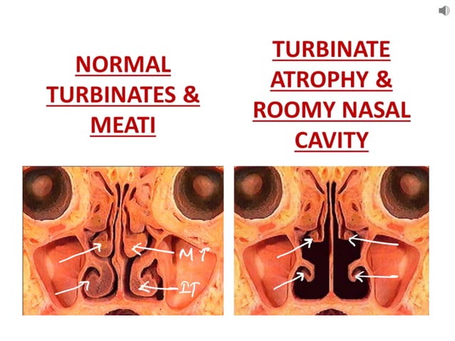 Atrophic rhinitis.pptx