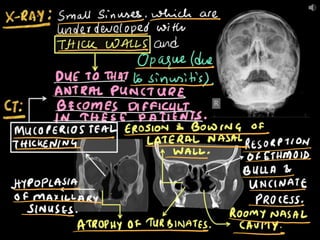 Atrophic rhinitis.pptx