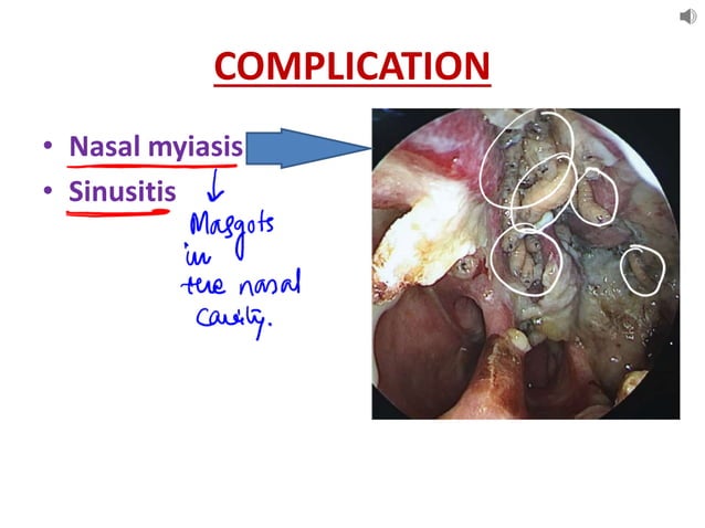 Atrophic rhinitis.pptx